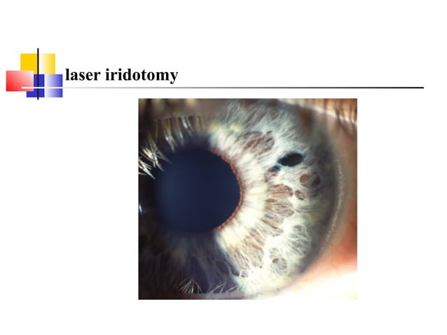 Pupil block glaucoma | PPT | Eye and Vision Conditions | Diseases and ...