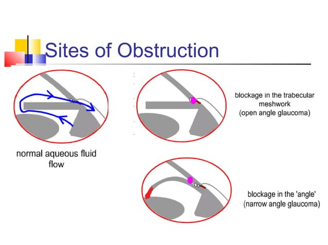 Pupil block glaucoma | PPT | Eye and Vision Conditions | Diseases and ...