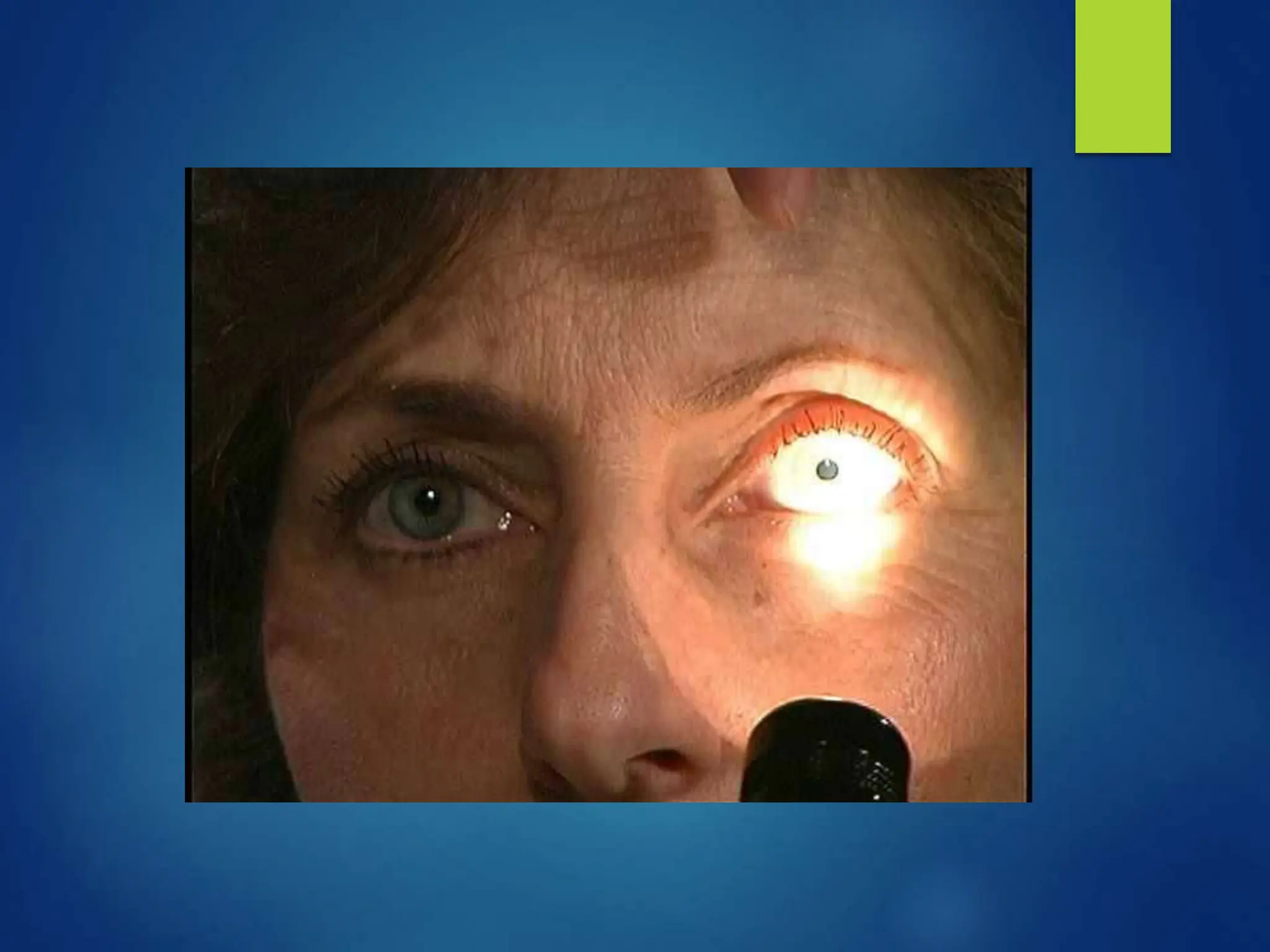 pupil examination step by step for ophthalmic exam.pptx