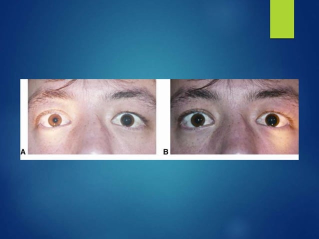 pupil examination step by step for ophthalmic exam.pptx