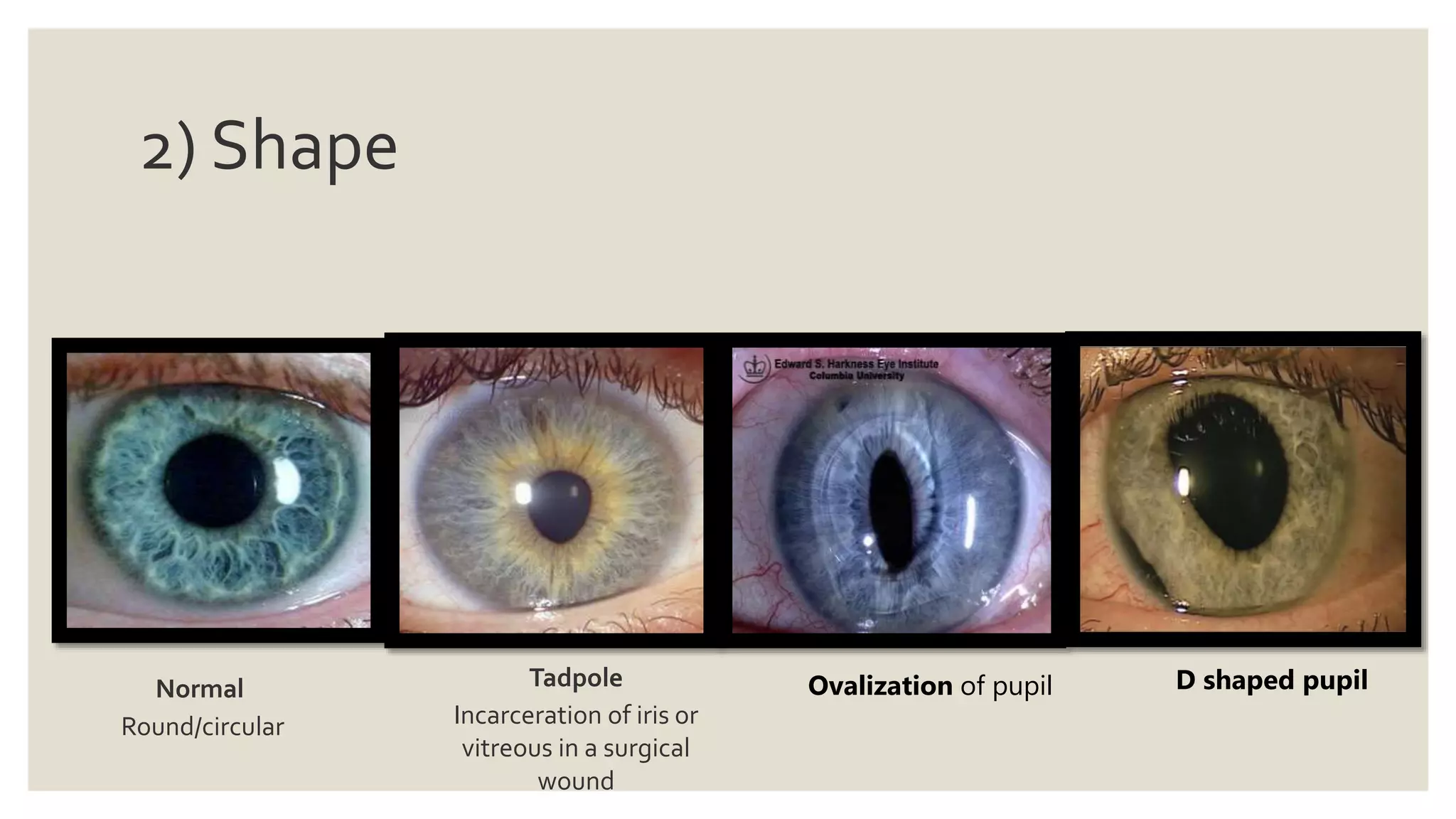Pupil examination | PPTX