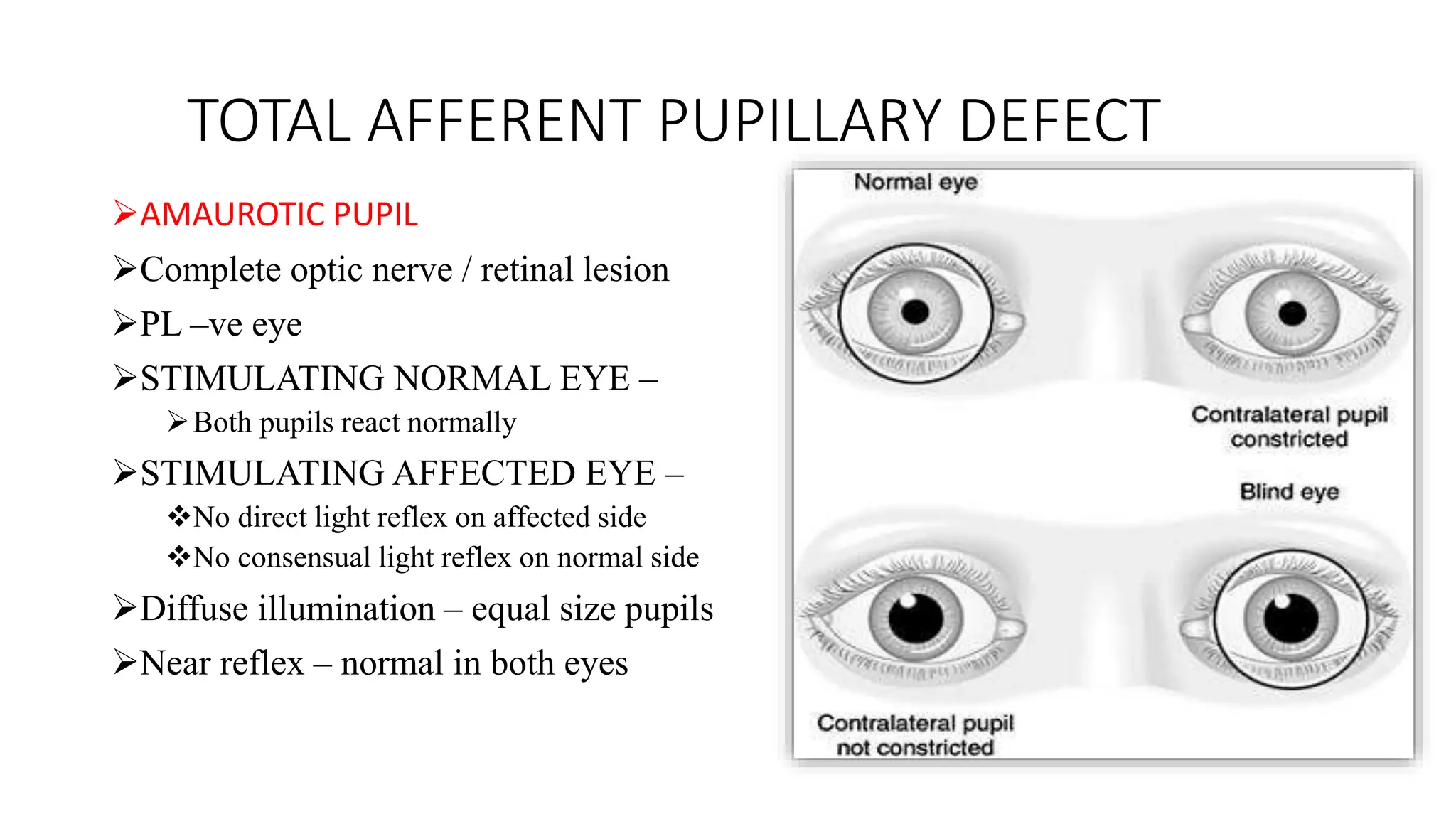PUPILLARY ABNORMALITIES and pupillary reflexes | PPTX