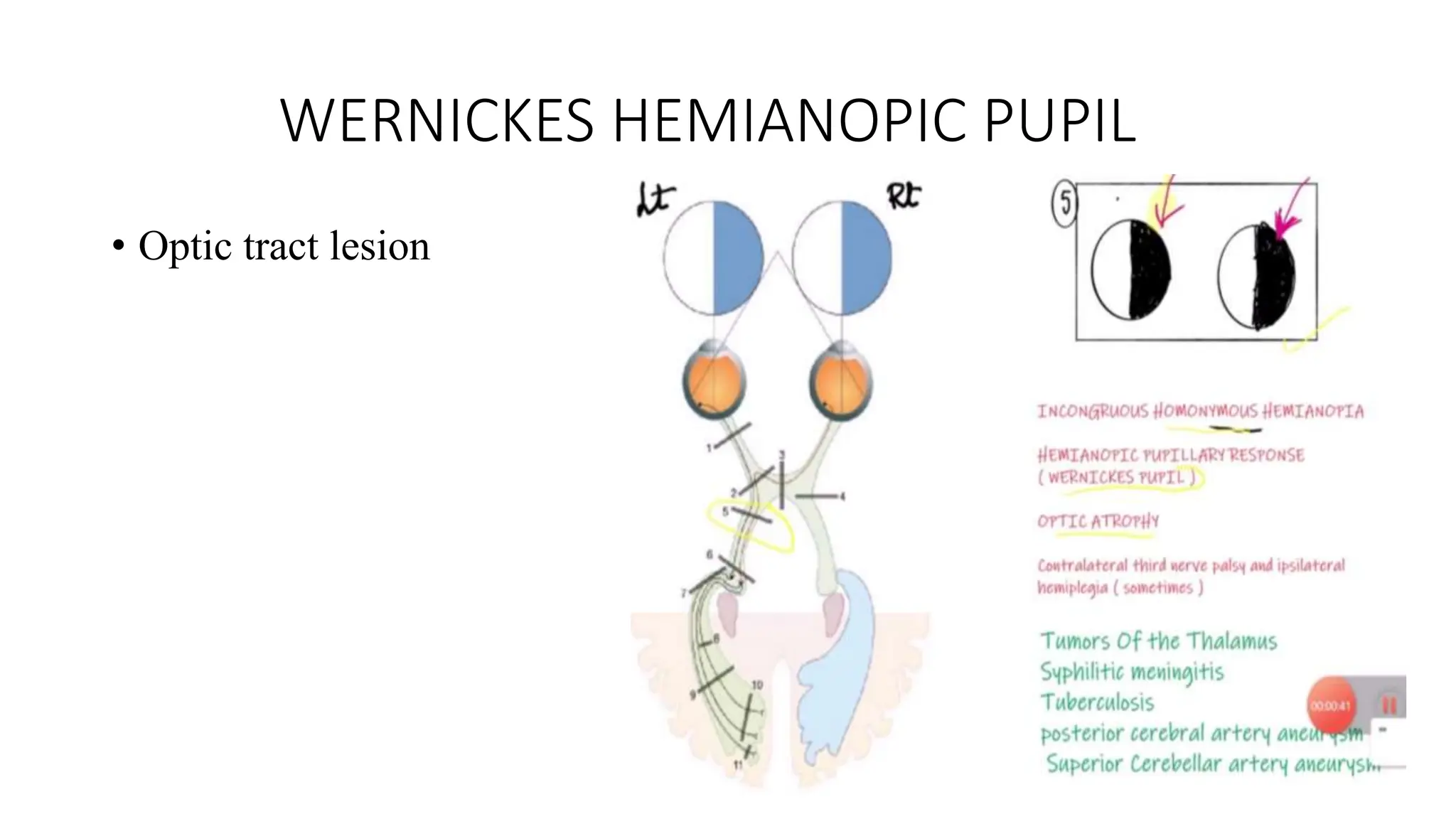 PUPILLARY ABNORMALITIES and pupillary reflexes | PPTX