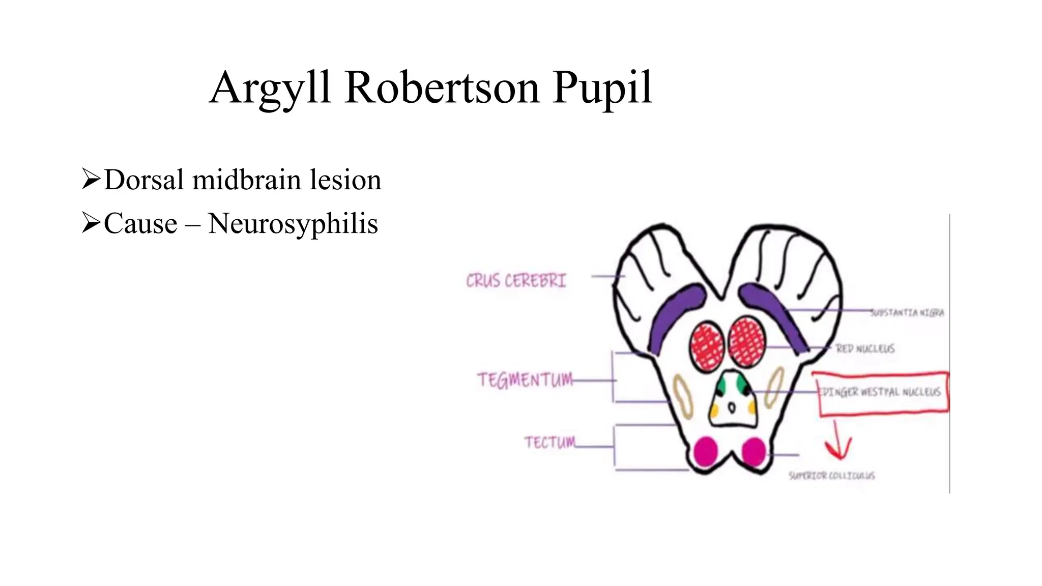 PUPILLARY ABNORMALITIES and pupillary reflexes | PPTX