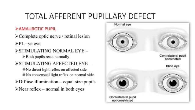 PUPILLARY ABNORMALITIES and pupillary reflexes | PPTX