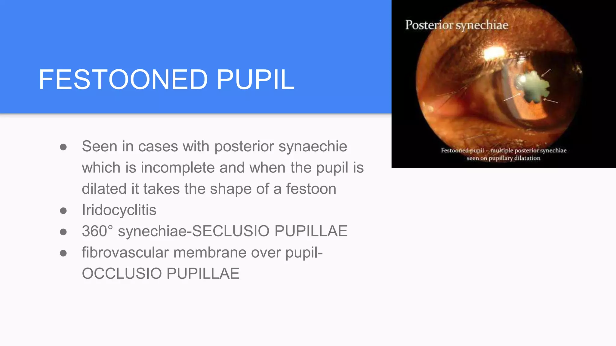 Pupillary abnormalities new 1 | PPTX