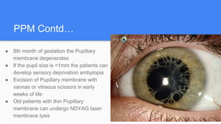 Partial Persistent Pupillary Membrane