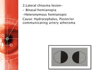 Pupillary and visual pathway | PPTX