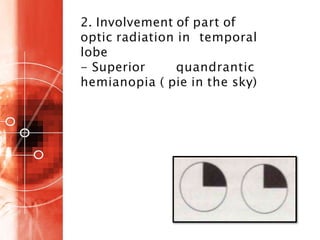 Pupillary and visual pathway | PPTX