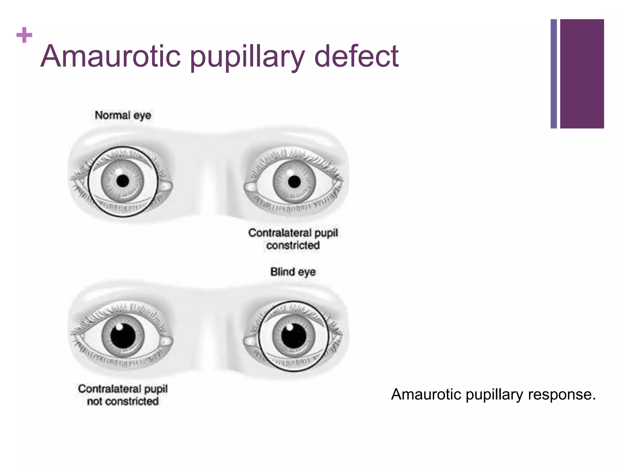 Pupillary defect | PPTX