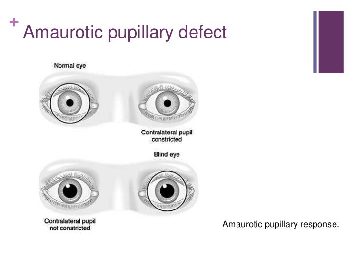Pupillary defect