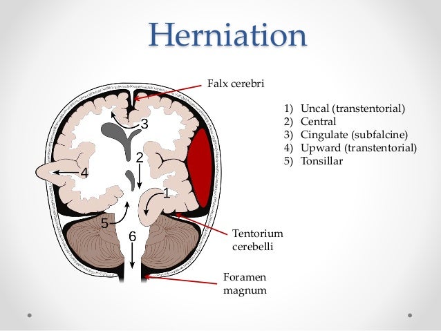 Pupillary dilatation in head injury