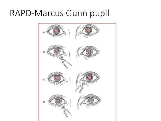 Afferent Pupillary Pathway