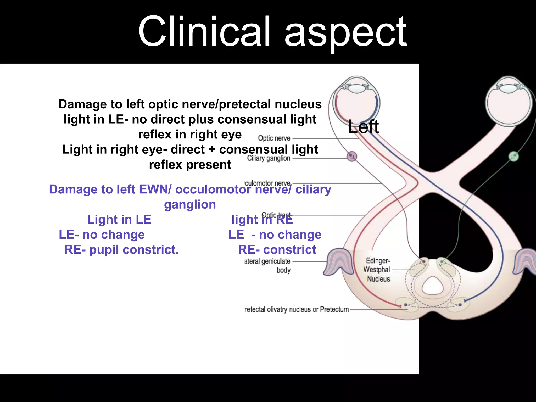 Pupillary pathway and its abnormality. | PPTX