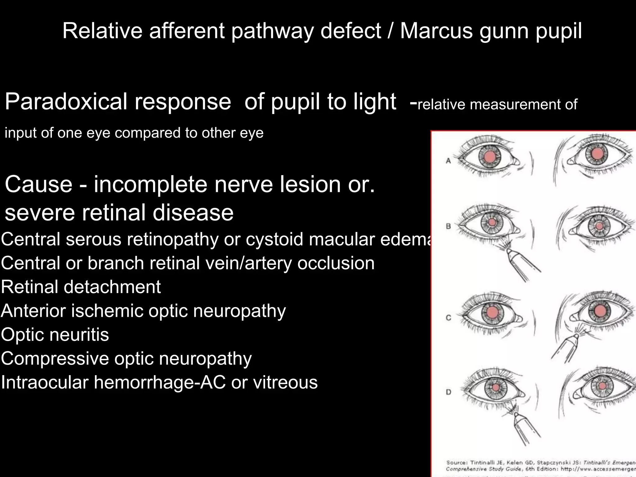 Pupillary pathway and its abnormality. | PPTX