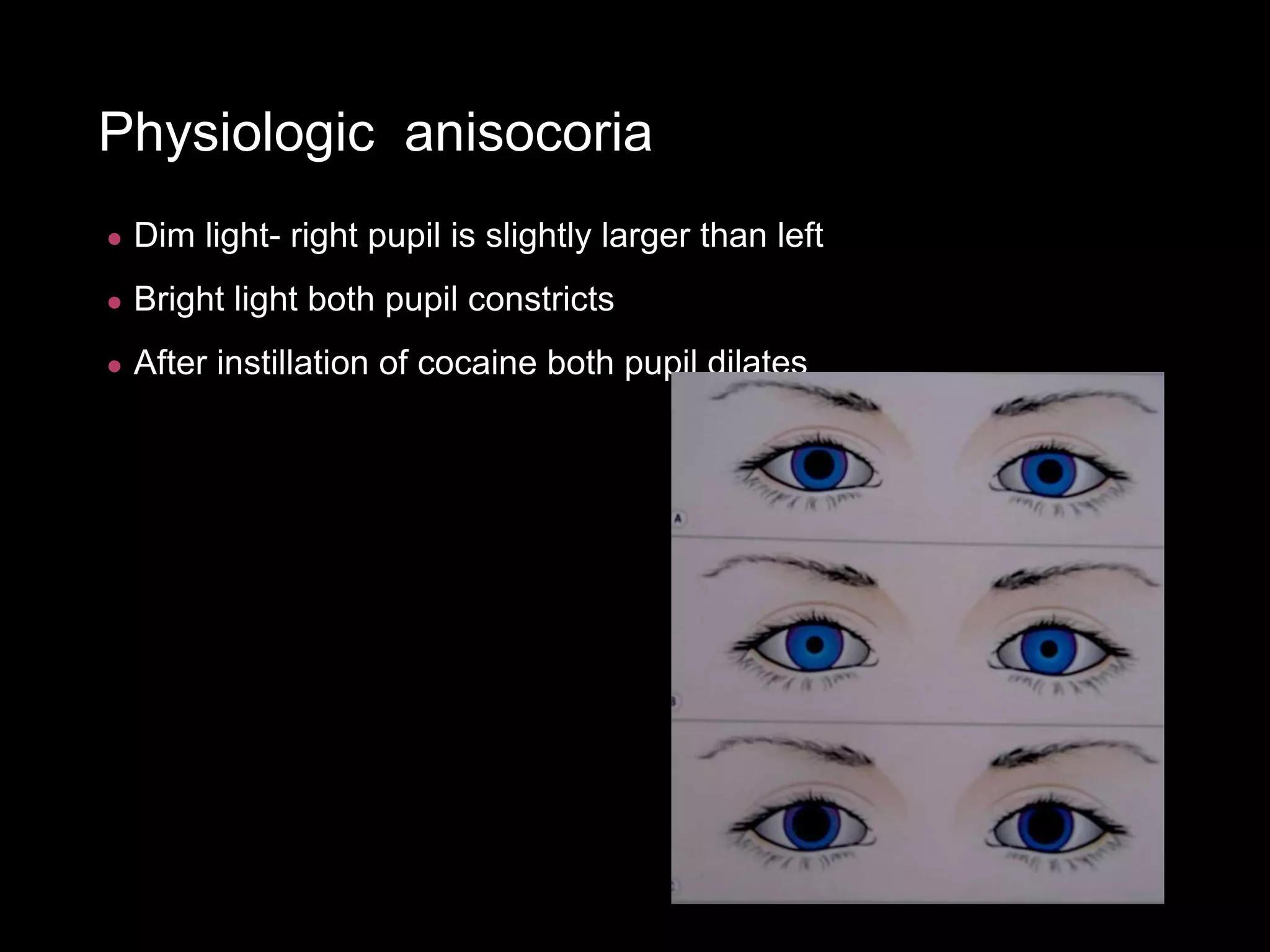 Pupillary pathway and its abnormality. | PPTX