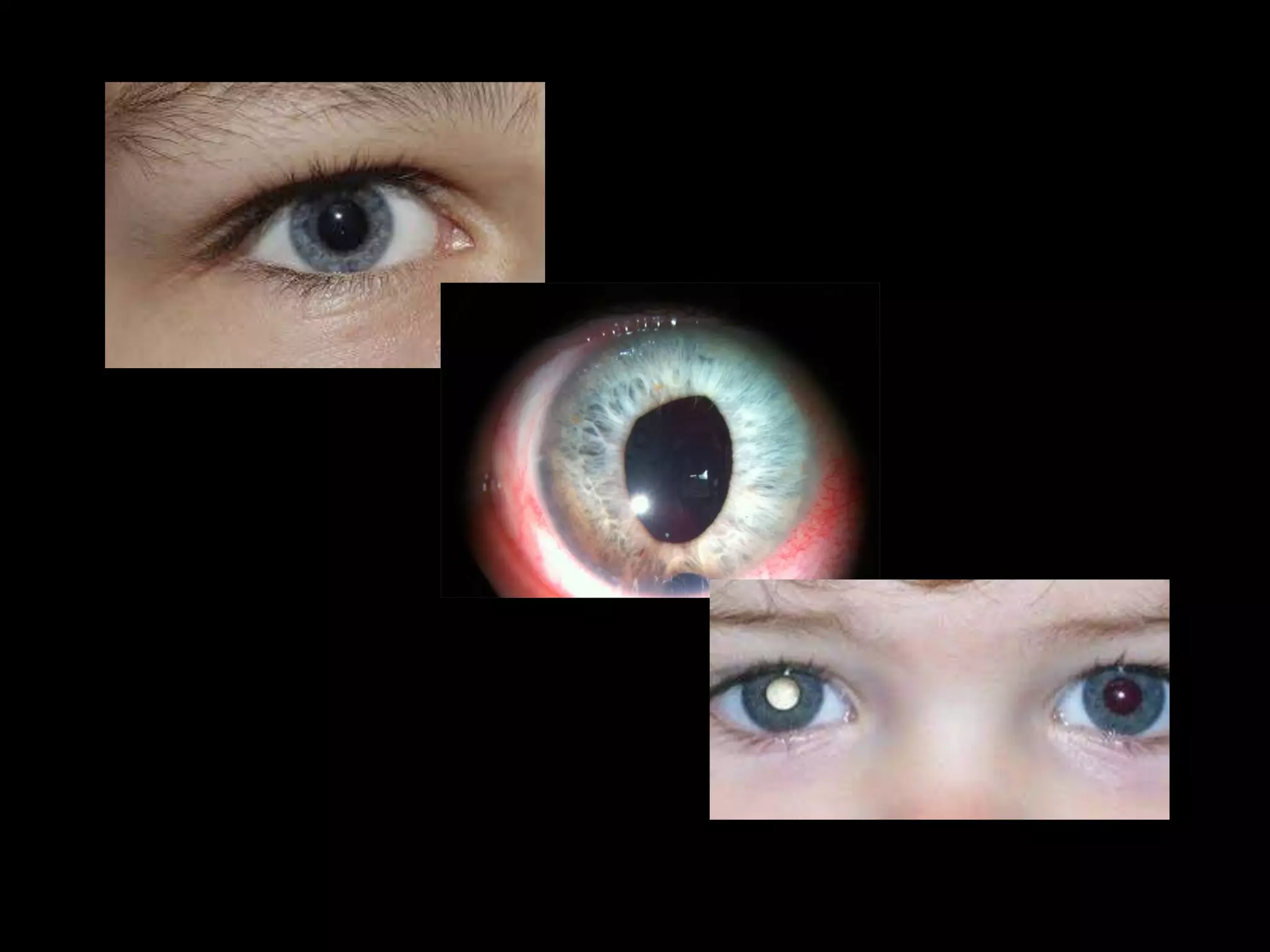 Pupillary pathway and its abnormality. | PPTX