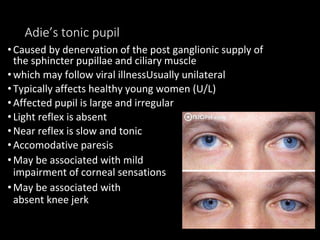 Pupillary pathway and its abnormality. | PPTX