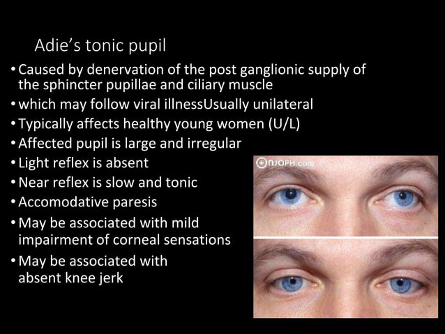 Pupillary pathway and its abnormality. | PPTX | Eye and Vision ...