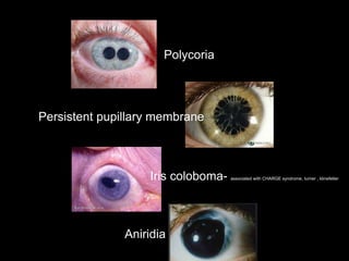 Pupillary pathway and its abnormality. | PPTX