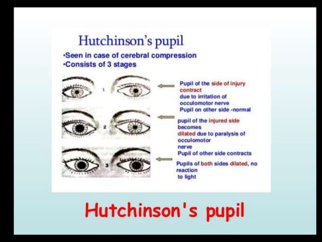 Pupillary pathway and its abnormality. | PPTX | Eye and Vision ...