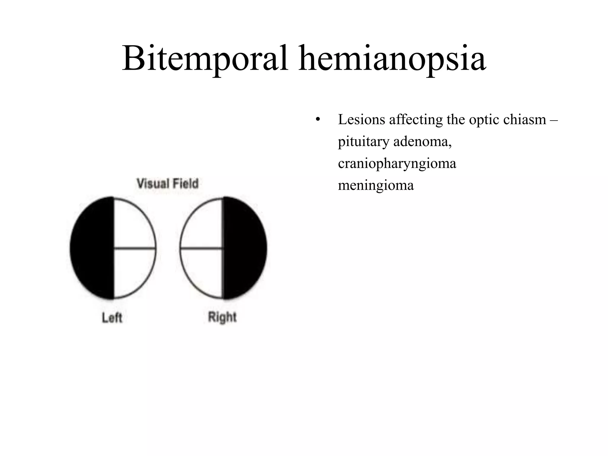 Pupillary pathway & field defects dr.k.srikanth-25.05.16