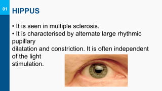 Pupillary react disorders | PPT