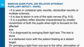 Pupillary react disorders | PPT