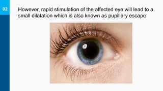 Pupillary react disorders | PPT