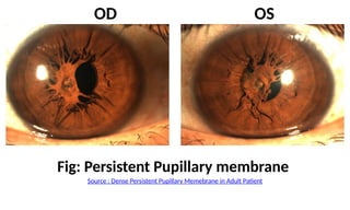 Pupil, Pupillary Reaction And it’s Abnormalities, | PPTX