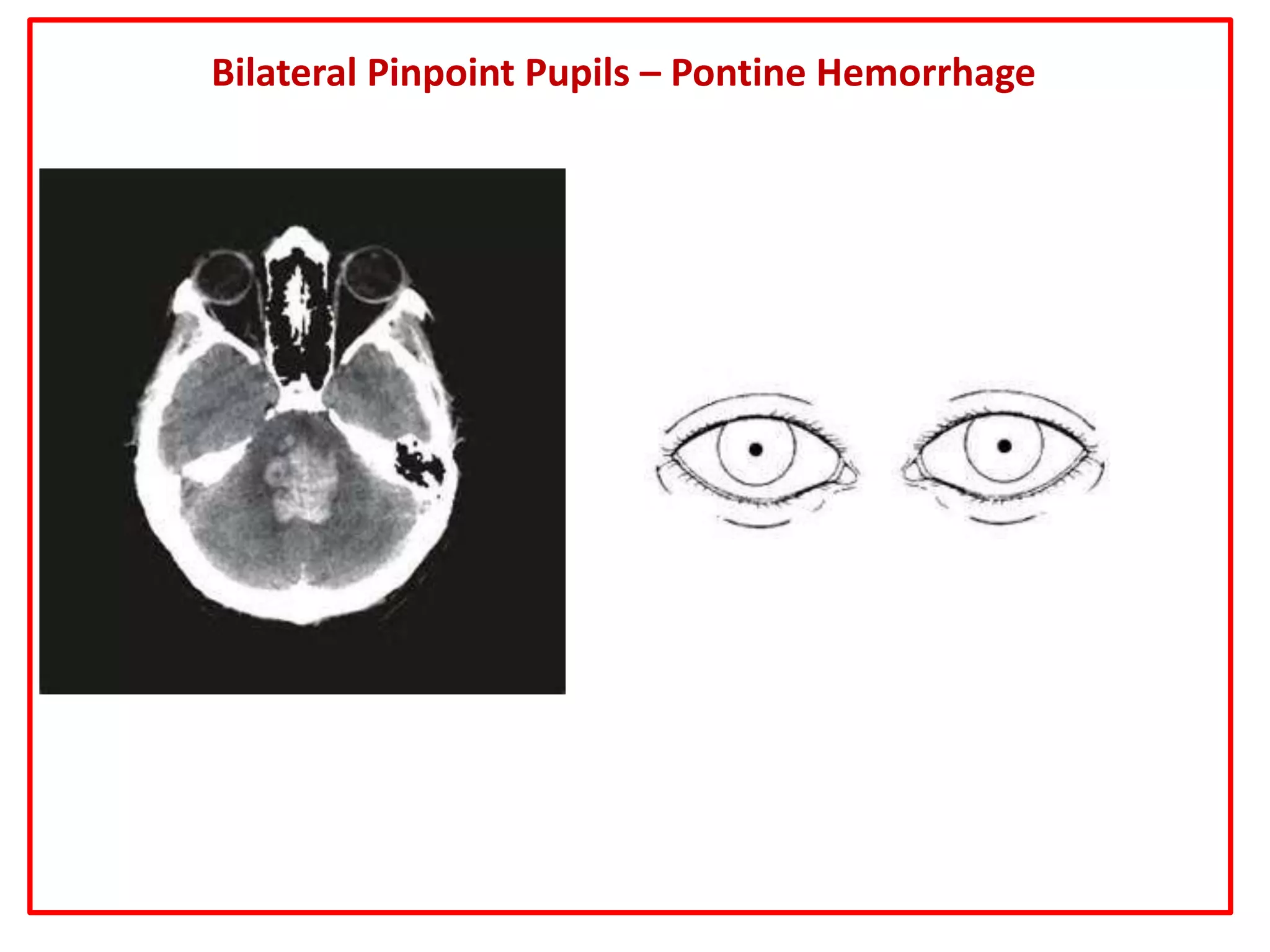 Pupils Neuroophthalmology Teaching Slides, Dr M D Mohire, Kolhapur ...