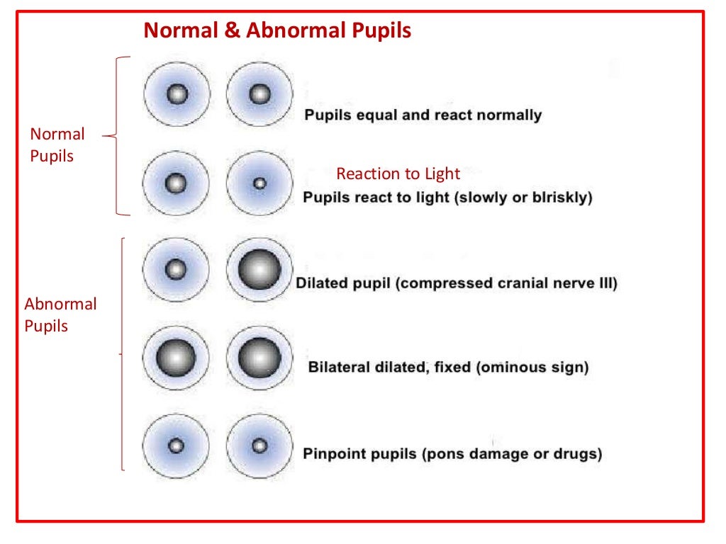 Pupils Neuroophthalmology Teaching Slides, Dr M D Mohire, Kolhapur, M…
