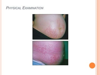 Pruritic Urticarial Papules And Plaques Of Pregnancy (puppp)