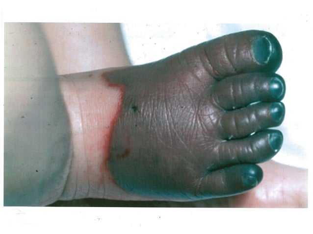 Pupura fulminans 2019 | PPT | First Aid | Injuries