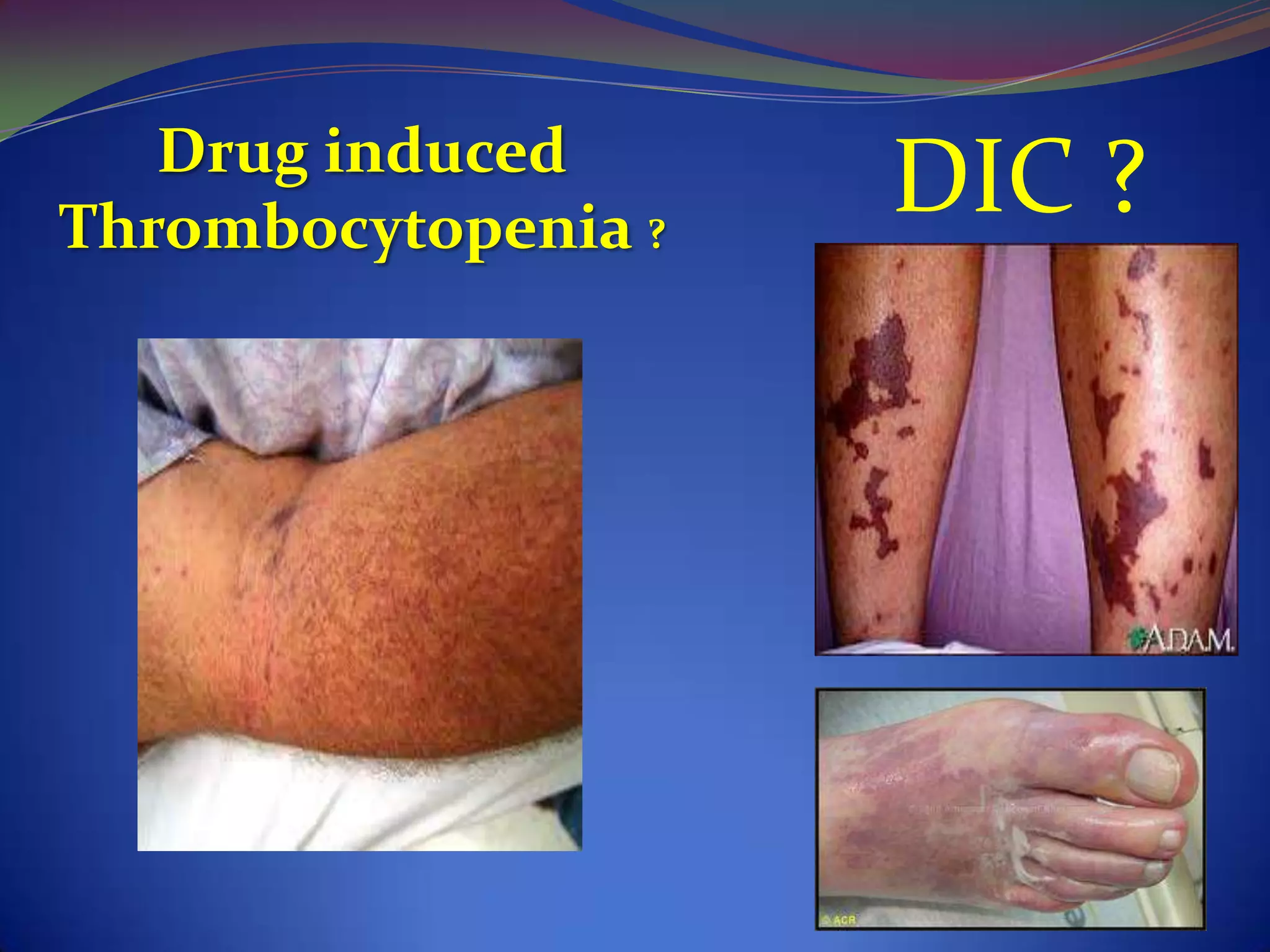 Pupura In A Patient With Lupus | PPTX