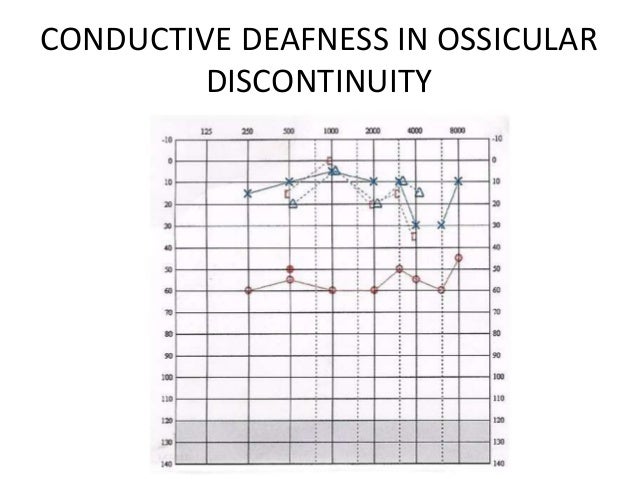 Pure tone audiometry