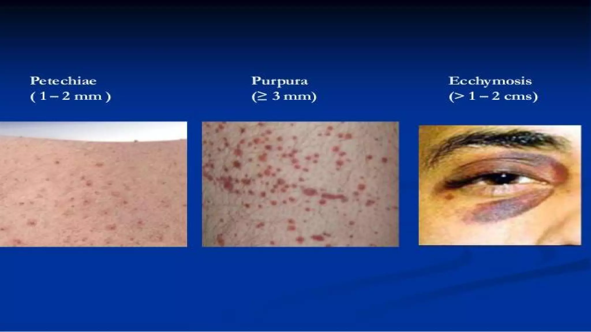 Purpura | PDF