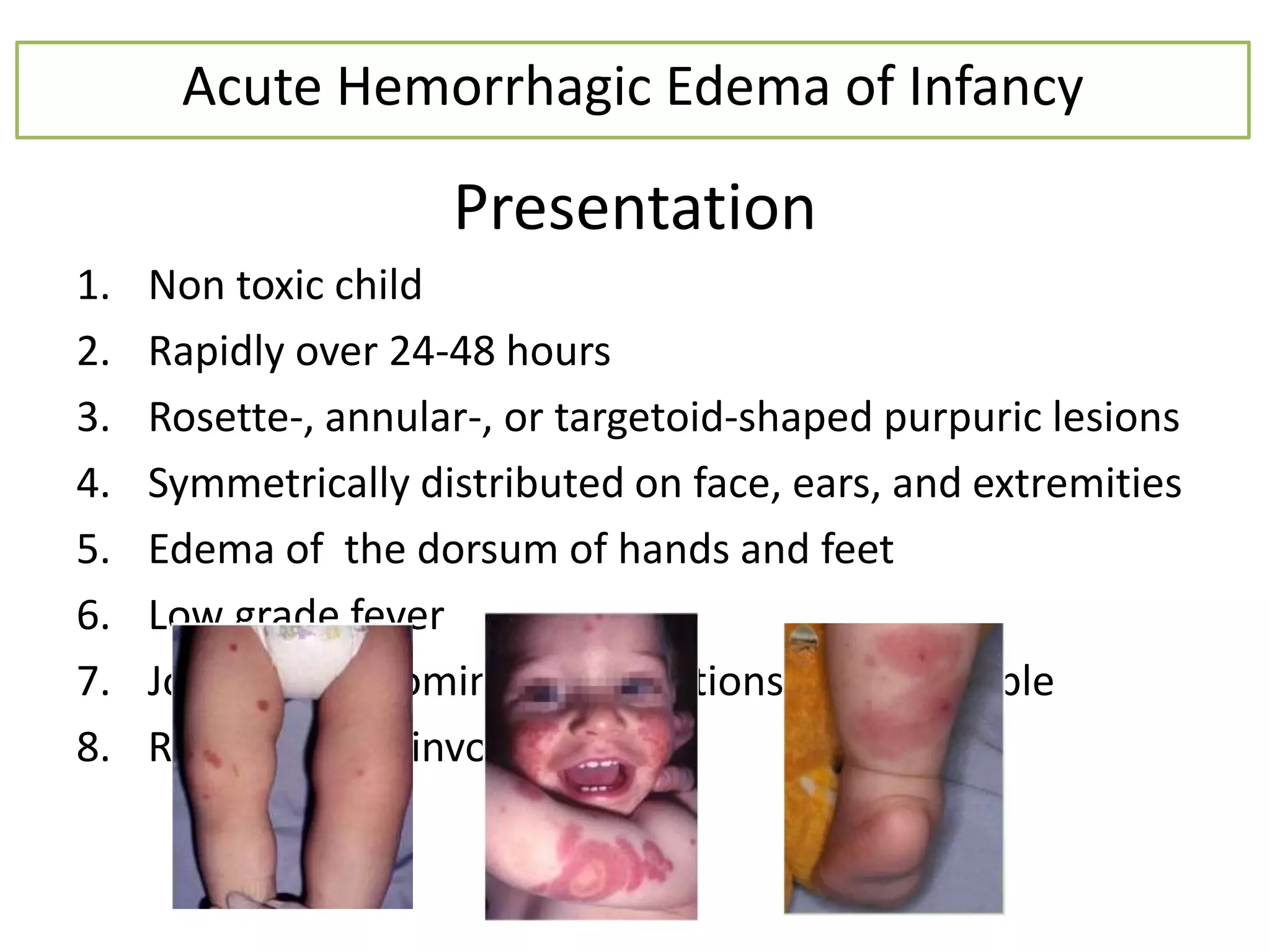 purpura ppt.pptx