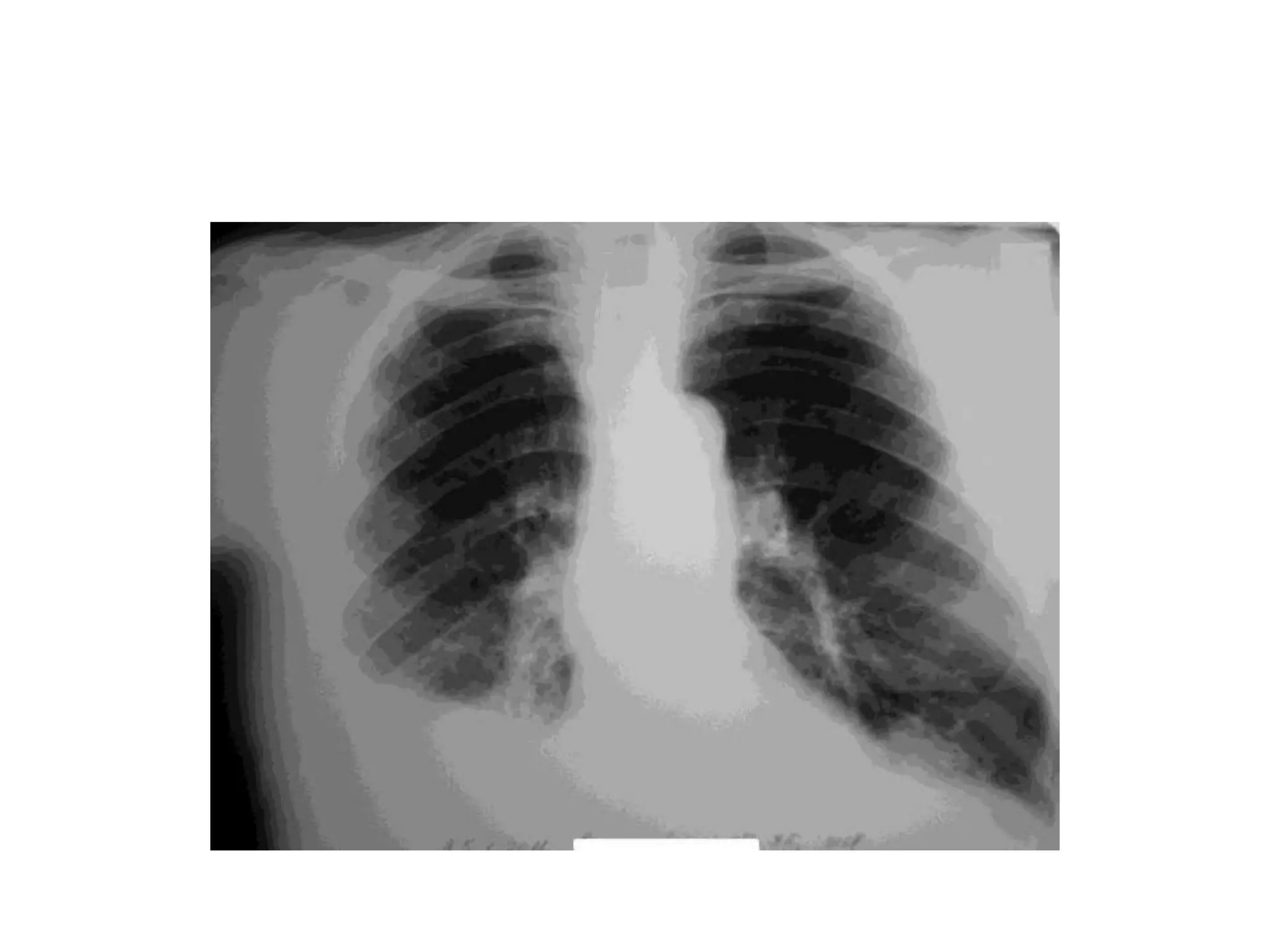 Purulent diseases of lungs and pleura | PPTX