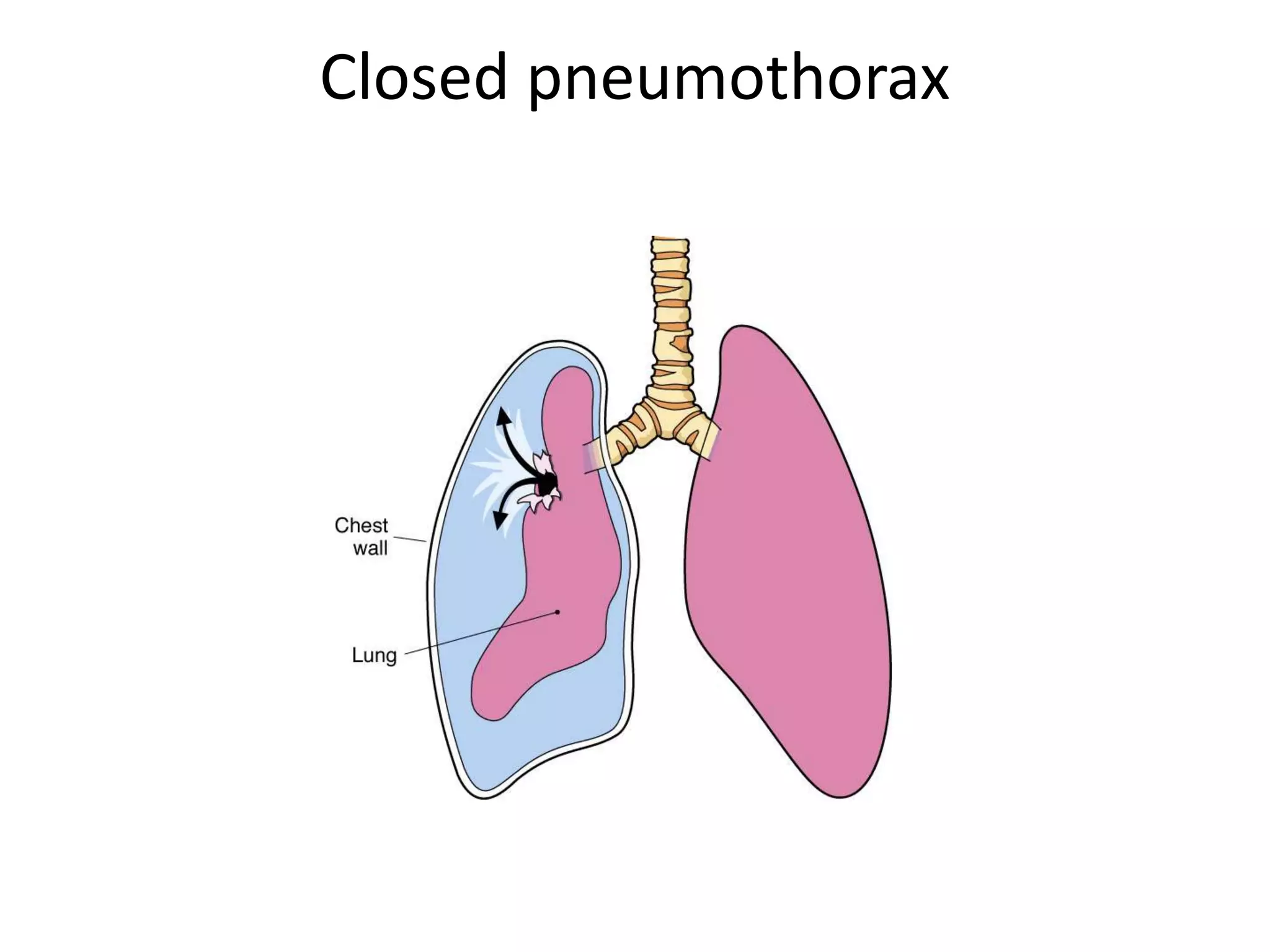 Purulent diseases of lungs and pleura | PPTX