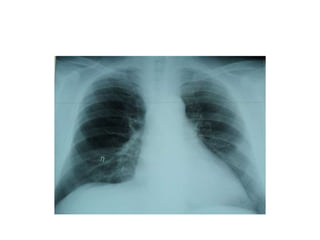 Purulent diseases of lungs and pleura | PPTX