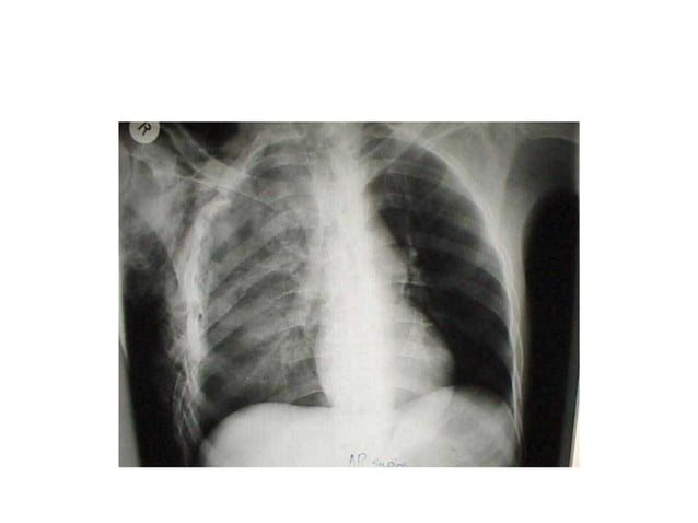 Purulent diseases of lungs and pleura | PPT