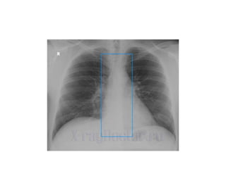 Purulent diseases of lungs and pleura | PPTX