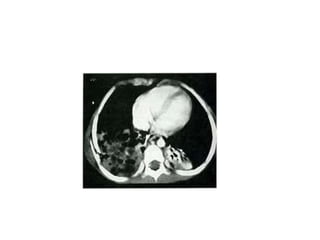 Purulent diseases of lungs and pleura | PPTX