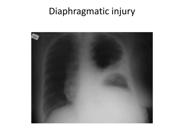 Purulent diseases of lungs and pleura | PPT