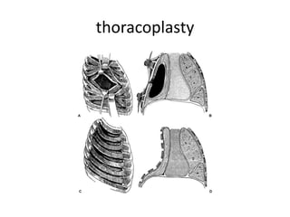 Purulent diseases of lungs and pleura | PPTX