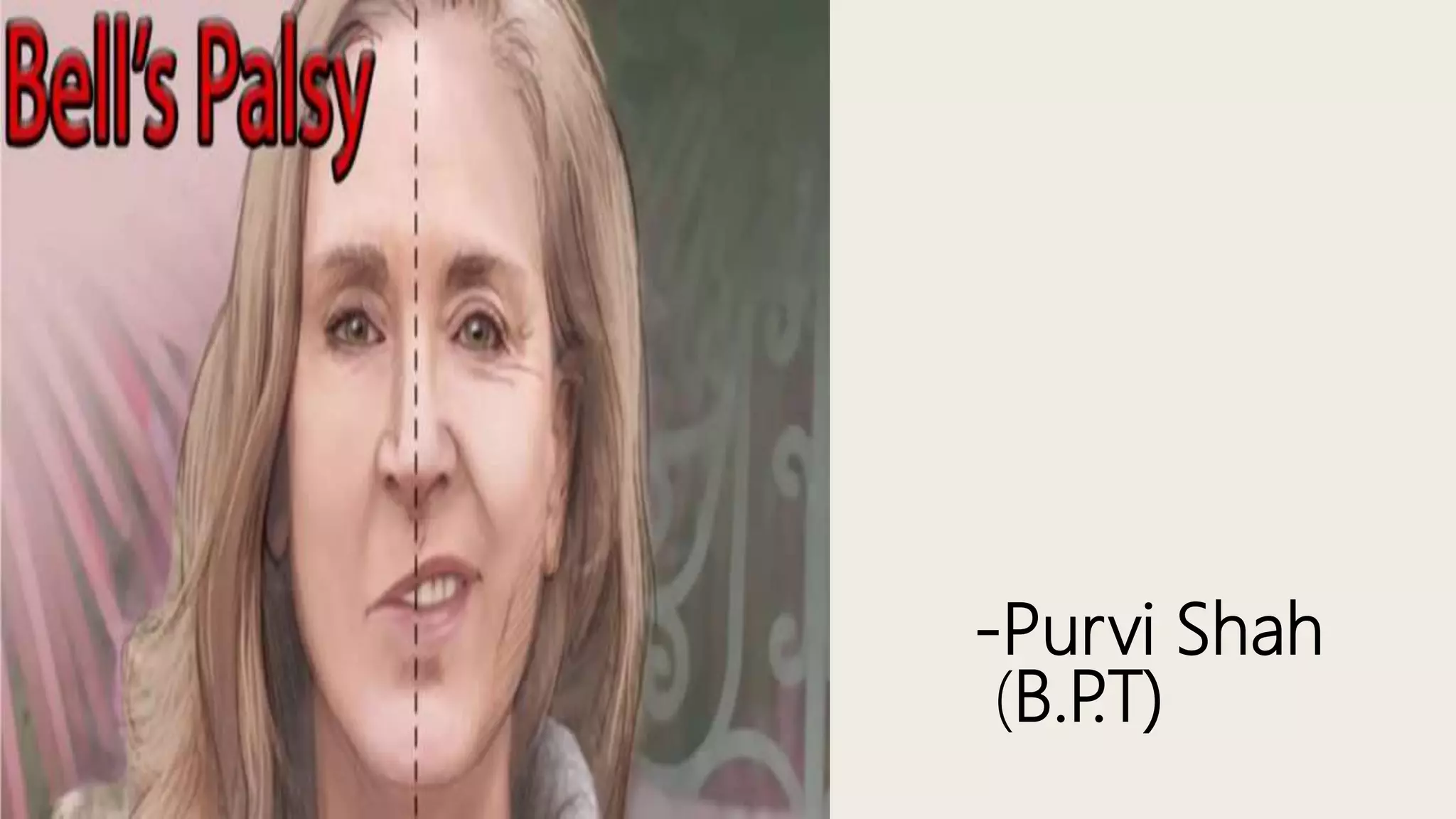 Bell's Palsy ICIDH2 Purvi Shah PPT | PPTX