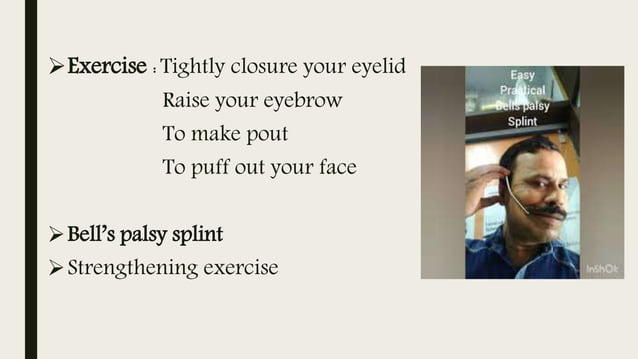 Bell's Palsy ICIDH2 Purvi Shah PPT | PPT