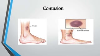 Purvi shah contusion ppt | PPTX