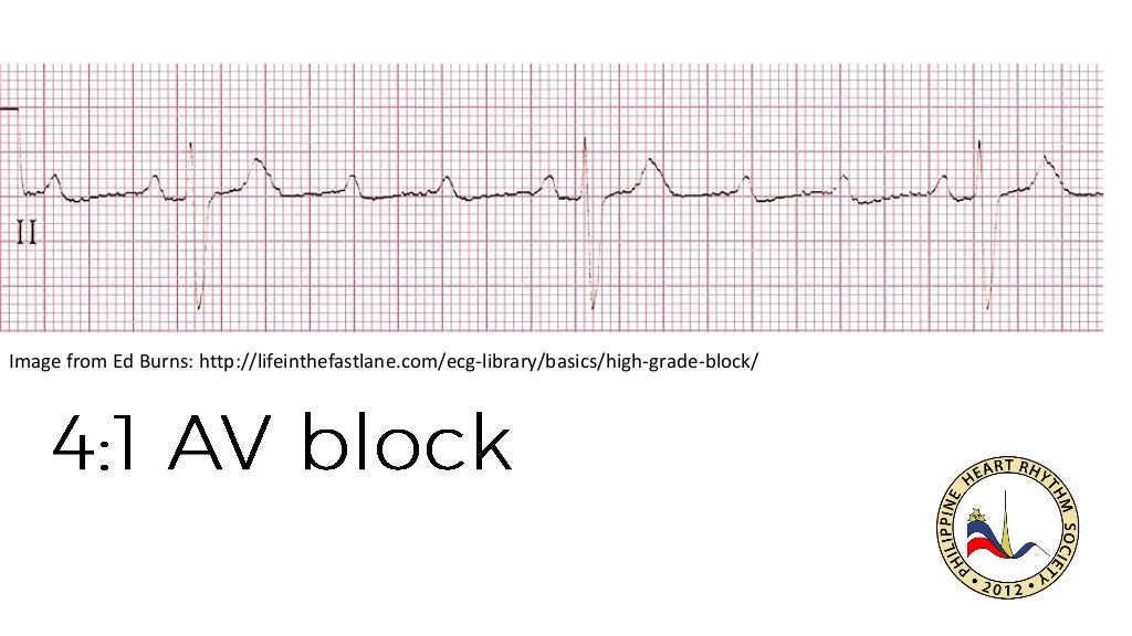 Bradyarrhythmia Lecture PHRS 2015